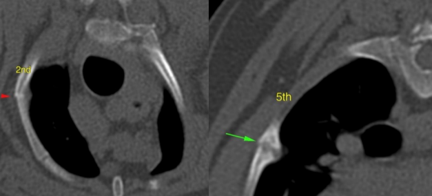 Burgess Diagnostics Ltd - CT: CT imaging used to identify Osteopenia ...
